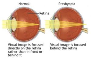 PresVu: India’s First Eye Drop for Presbyopia - Civilsdaily